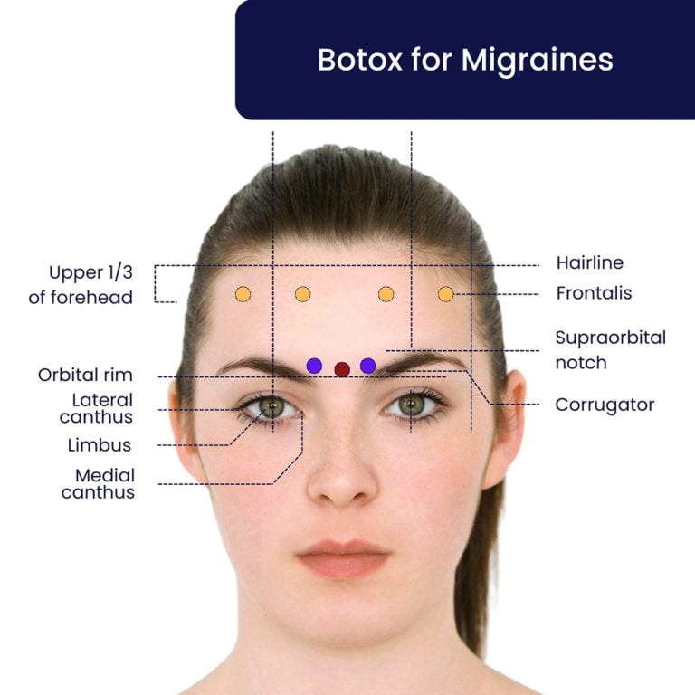 Botox for Migraines in Brooklyn, NYC & NJ