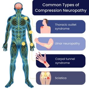 Compression Neuropathy Treatment Specialists in Brooklyn, NYC and NJ