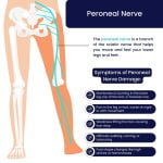 Peroneal Nerve Injury Treatment in Brooklyn, NYC & NJ | Peroneal Nerve ...