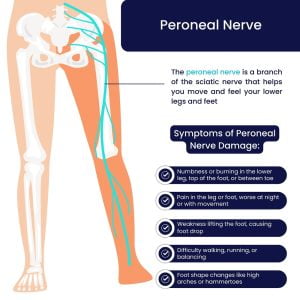 Peroneal Nerve Injury Treatment in Brooklyn, NYC & NJ | Peroneal Nerve ...