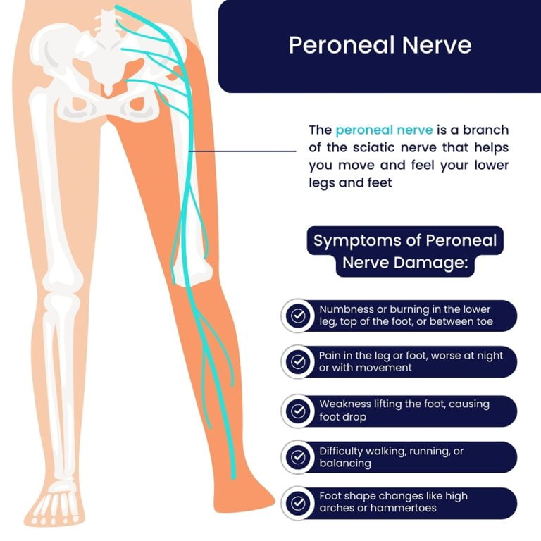 Peroneal Nerve Injury Treatment in Brooklyn, NYC & NJ | Peroneal Nerve ...