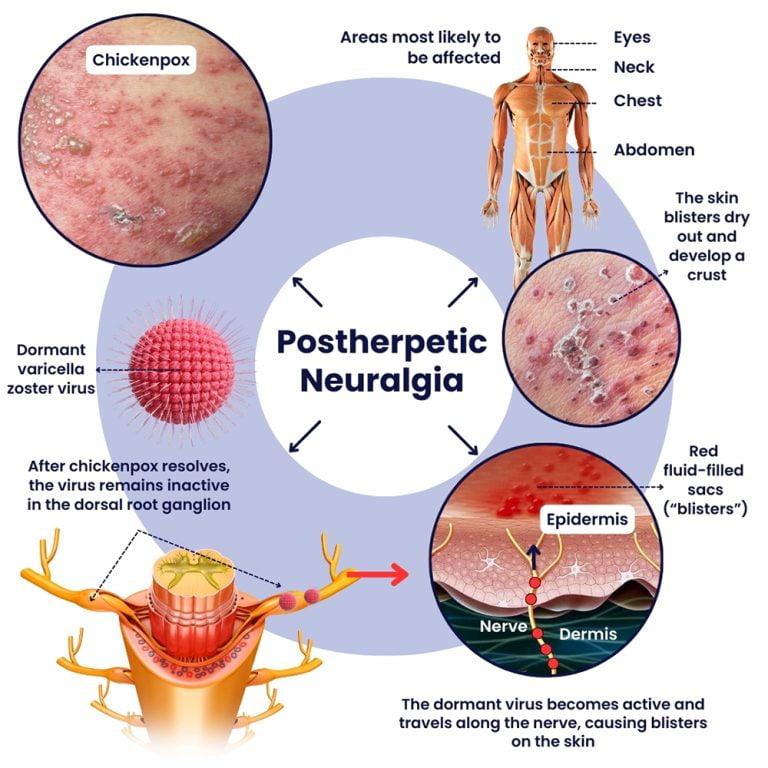Postherpetic Neuralgia Treatment in Brooklyn, NYC & NJ