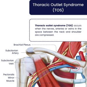 TOS Doctors in Brooklyn, NYC and NJ | Thoracic Outlet Syndrome Treatment
