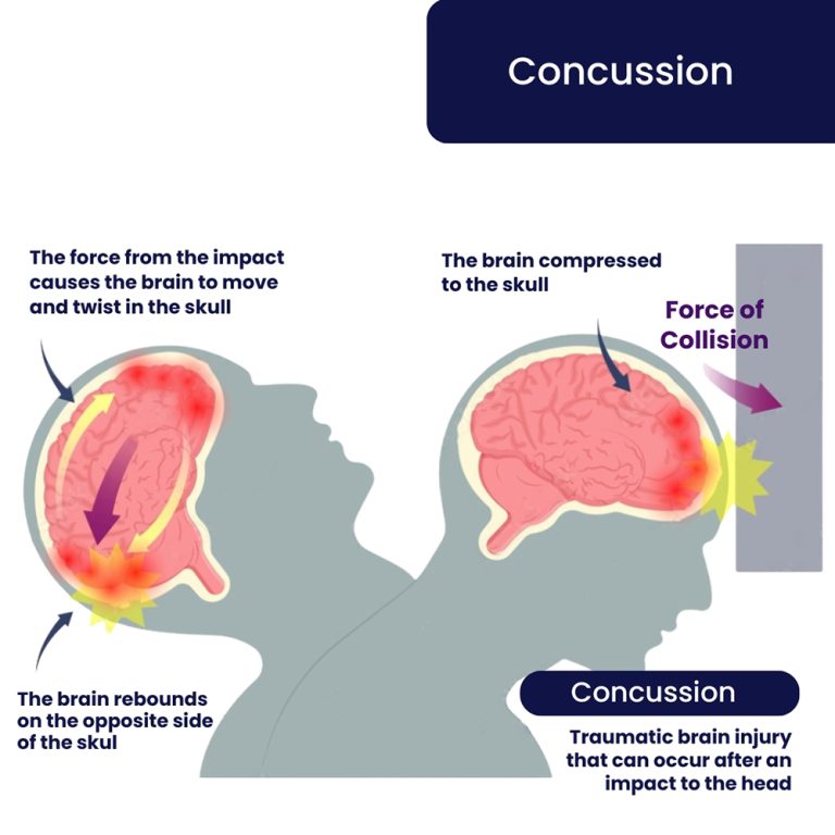 Concussion Treatment Doctor in Brooklyn, NYC & NJ