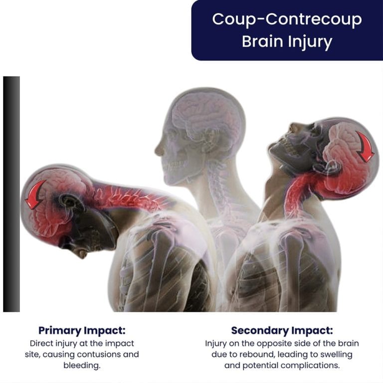 Coup-Contrecoup Brain Injury Treatment in Brooklyn, NYC & NJ
