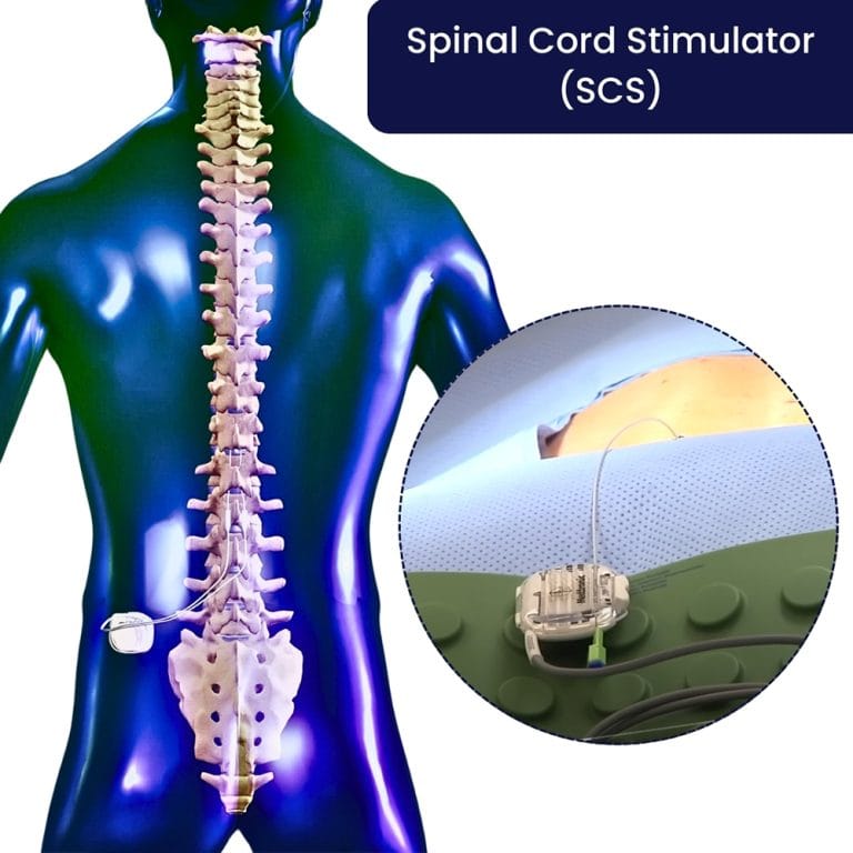 Spinal Cord Stimulator in Brooklyn, NYC & NJ | Nerve Stimulation Specialists