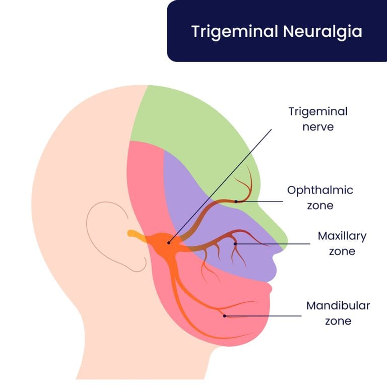 Trigeminal Neuralgia Treatment in Brooklyn, NYC & NJ - Facial Pain Specialist